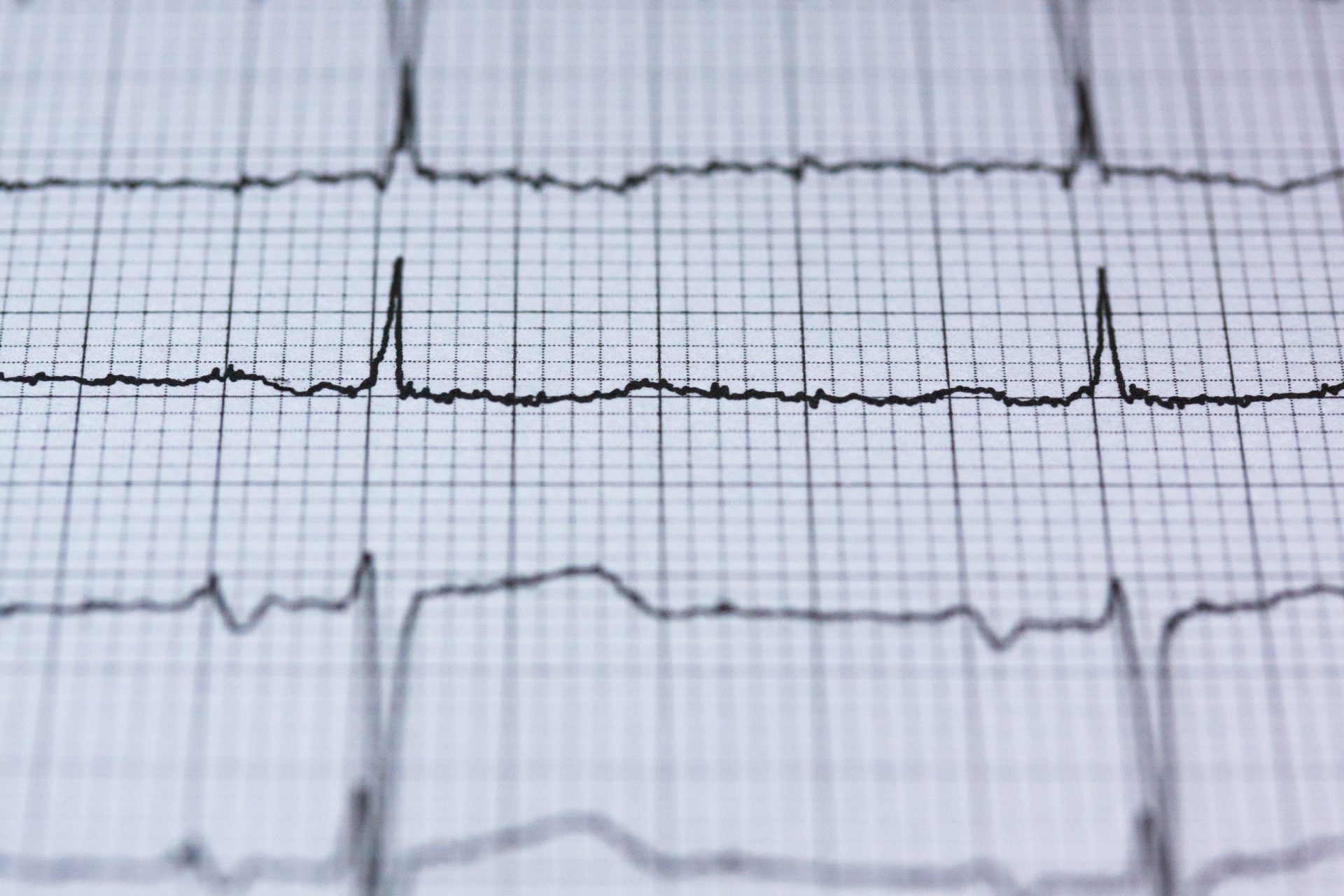 What Does an EKG Test For? | Westgate Family Physicians - Westgate ...